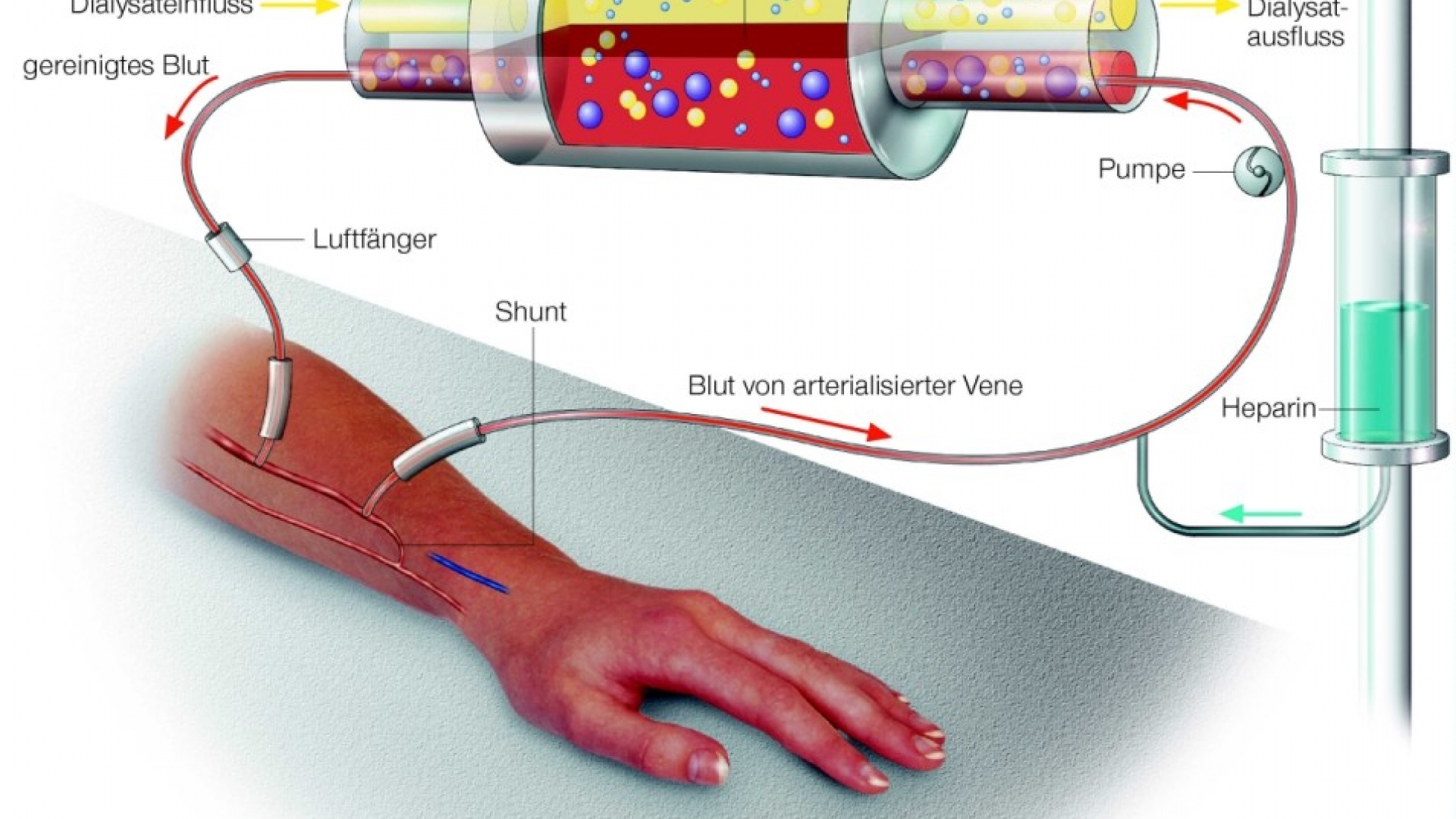 Dialyse (Medizin) | wissen.de