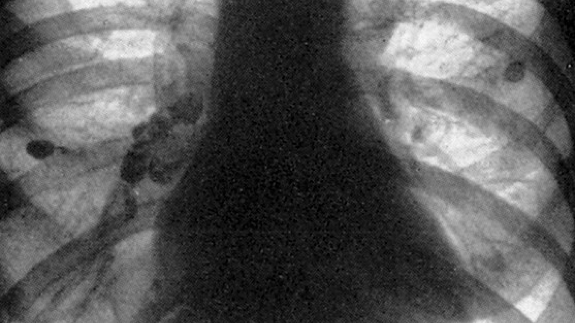 Tuberkulose (Humanmedizin) | wissen.de