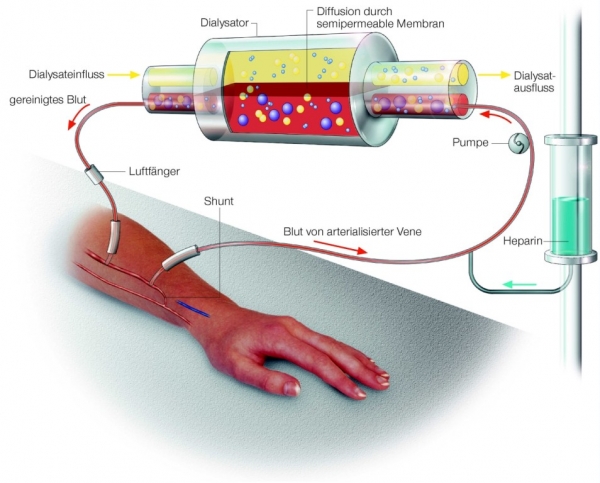 Dialyse (Medizin) | wissen.de