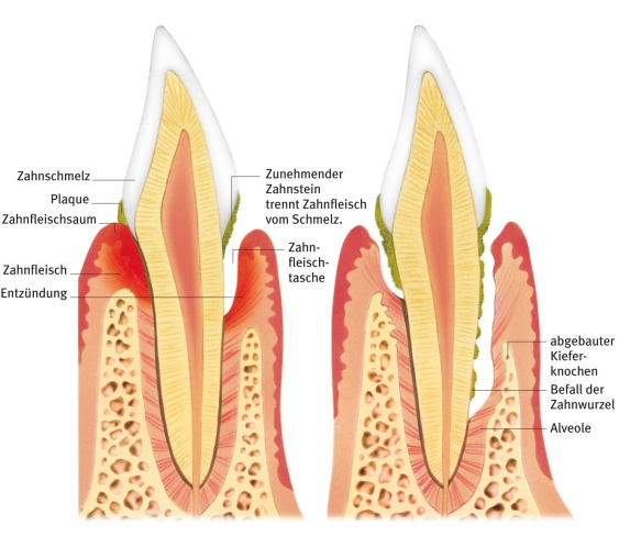 Parodontose aus dem Lexikon | wissen.de