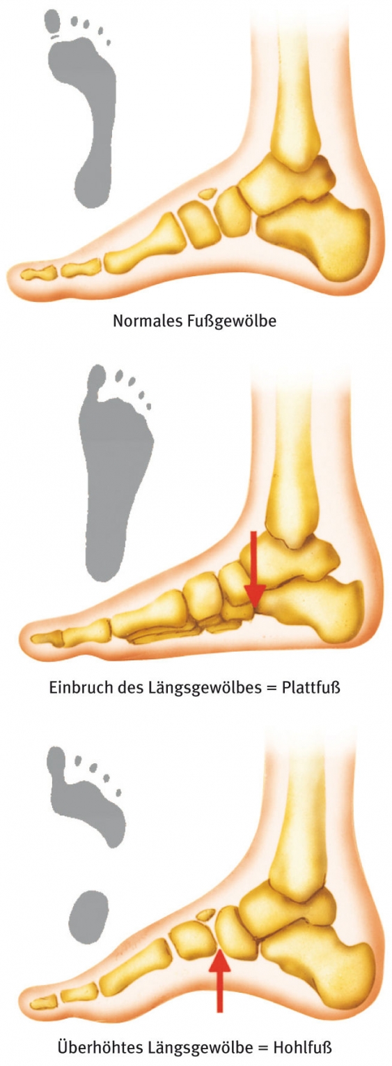 Plattfuß, aus dem Gesundheitslexikon | Gesundheit, Medizin und ...