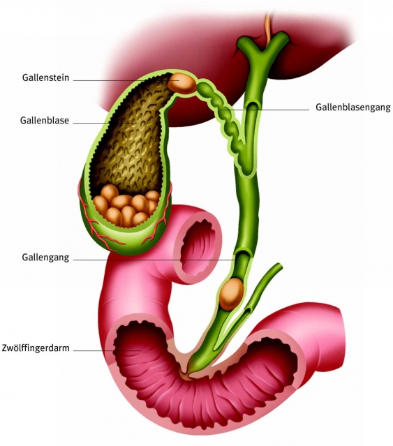 Galle, aus dem Gesundheitslexikon | Gesundheit, Medizin und Heilkunde ...